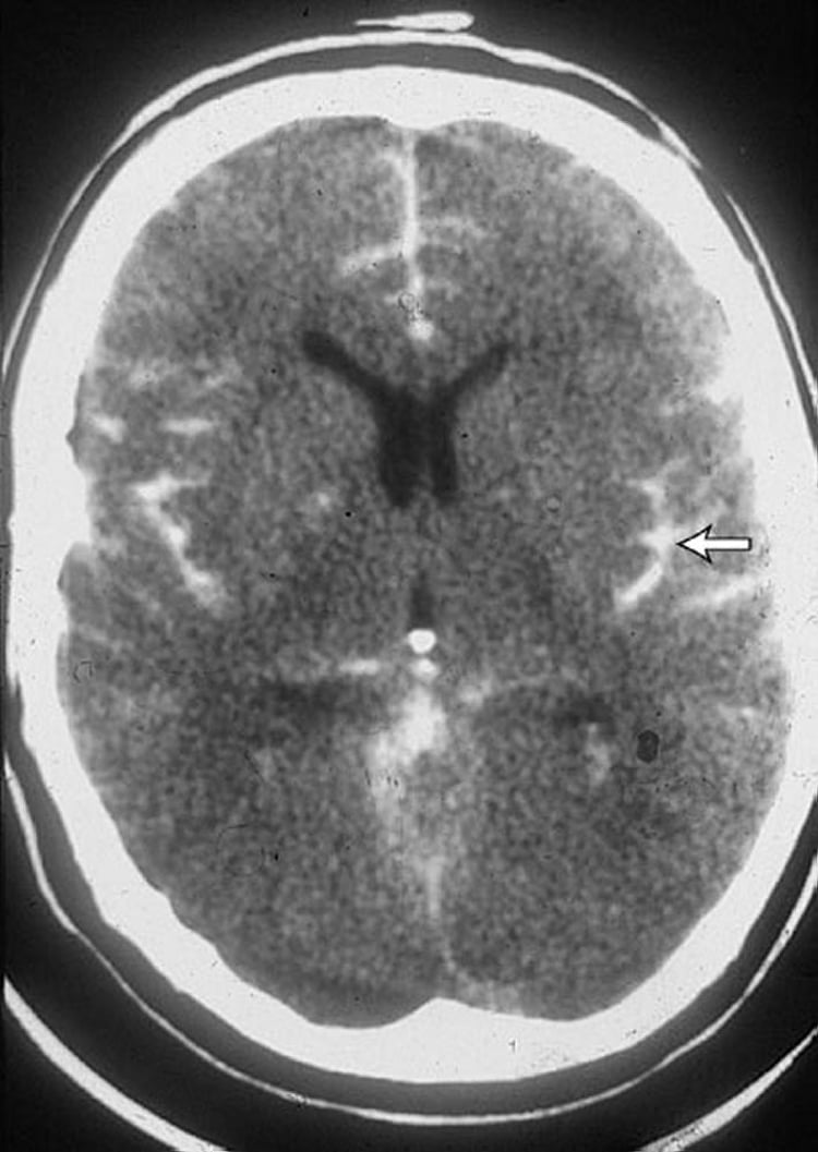 Subarachnoid Hemorrhage (SAH) - Subarachnoid Hemorrhage (SAH) - MSD ...