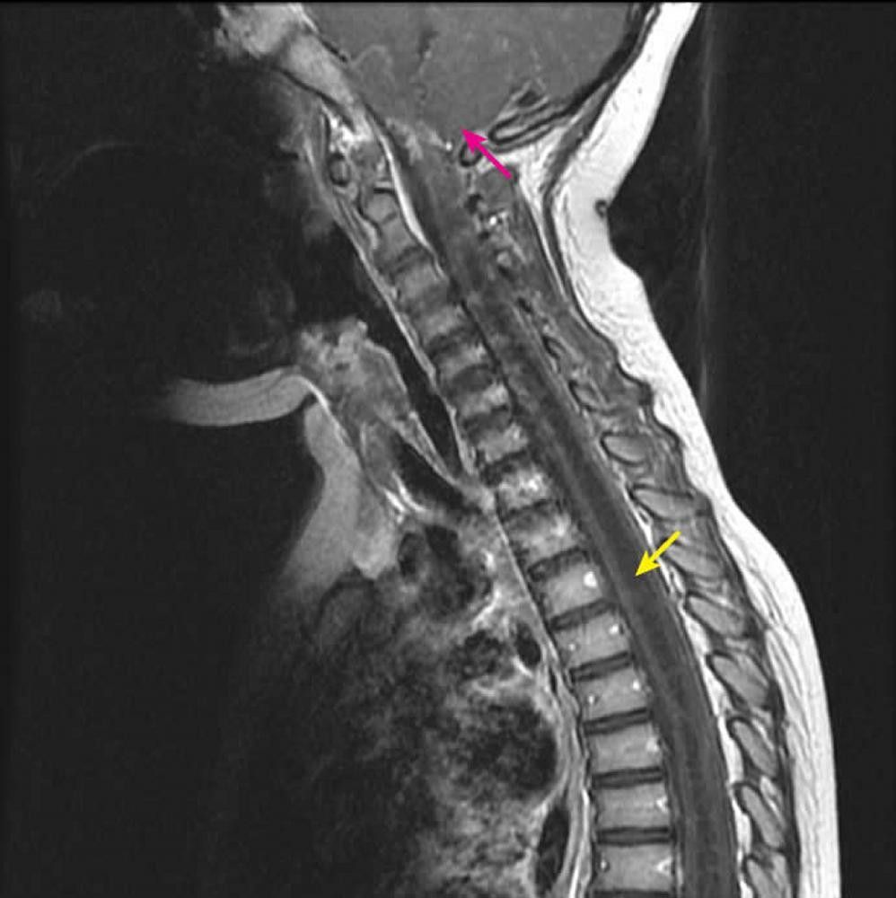 Syrinx of the Spinal Cord or Brain Stem - Neurology - Merck Manual ...