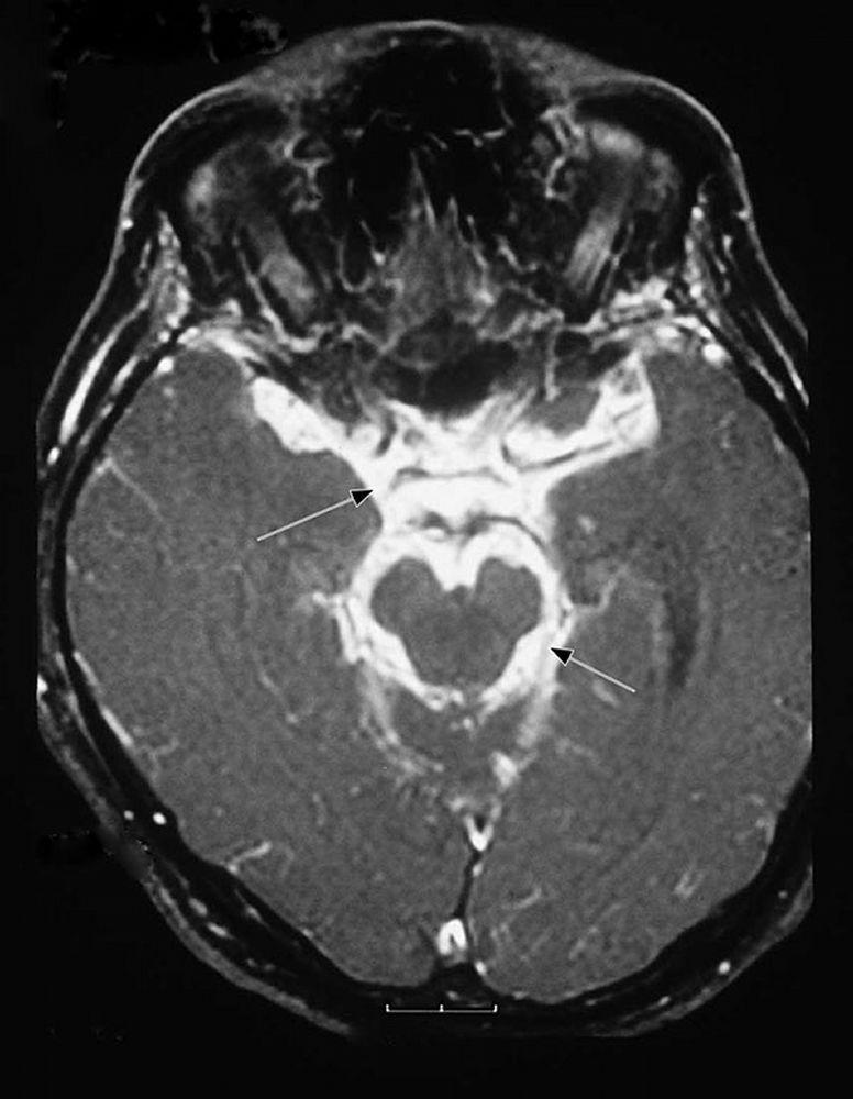 Meningitis subaguda y crónica - Trastornos neurológicos - Manual MSD ...