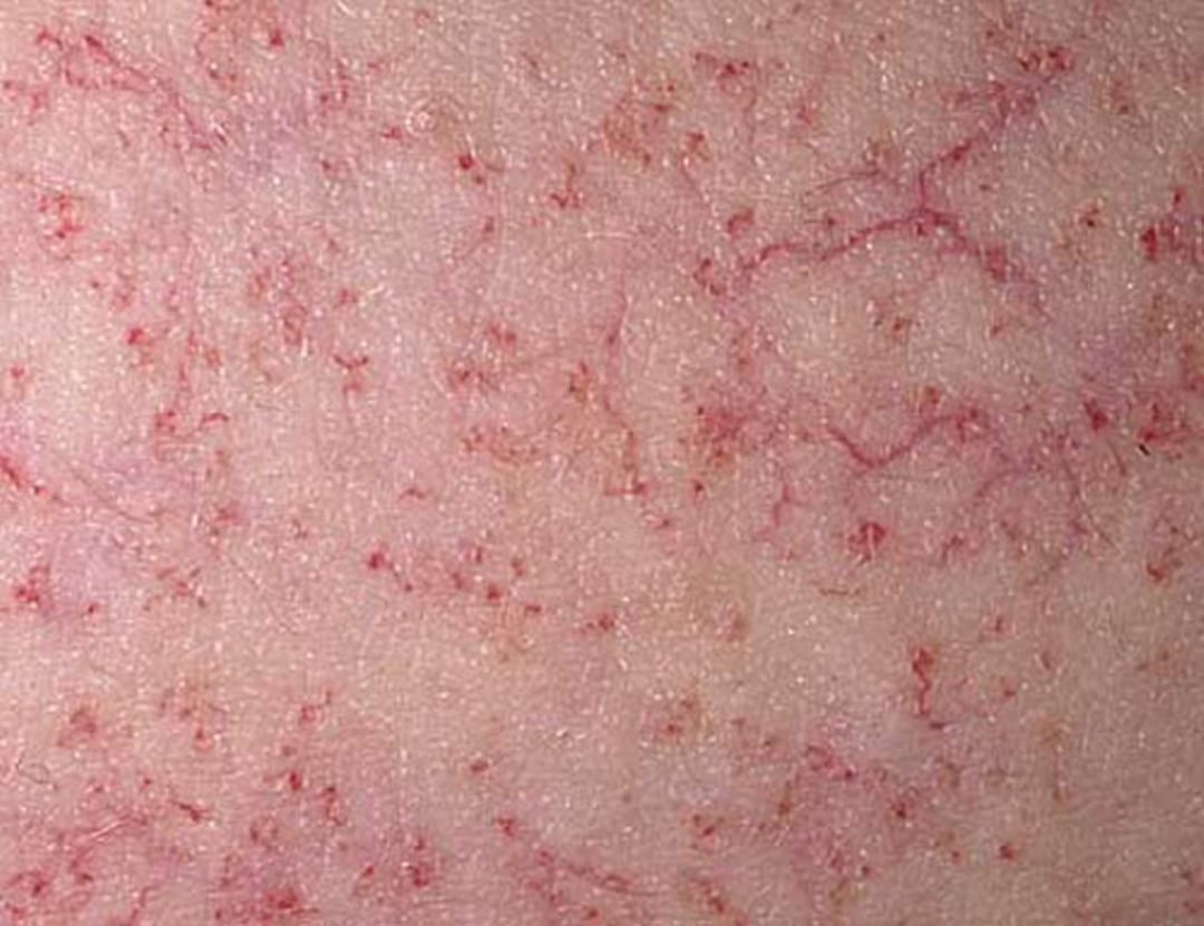 Image:Telangiectasias-Merck Manual Professional Edition