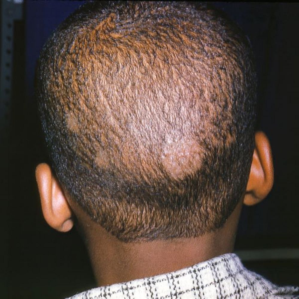 Tinea Capitis (Scalp Ringworm) - Dermatologic Disorders - Merck Manual ...