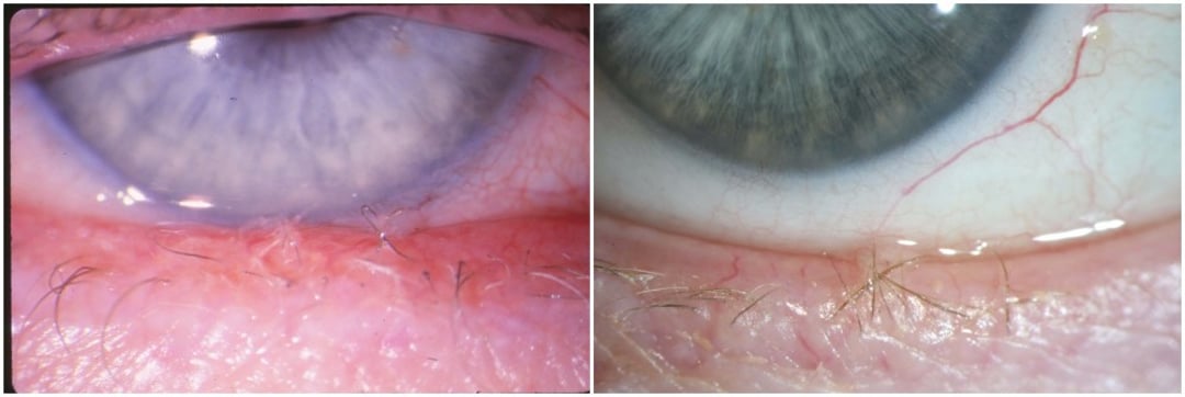 Trichiasis - Eye Disorders - Merck Manual Professional Edition