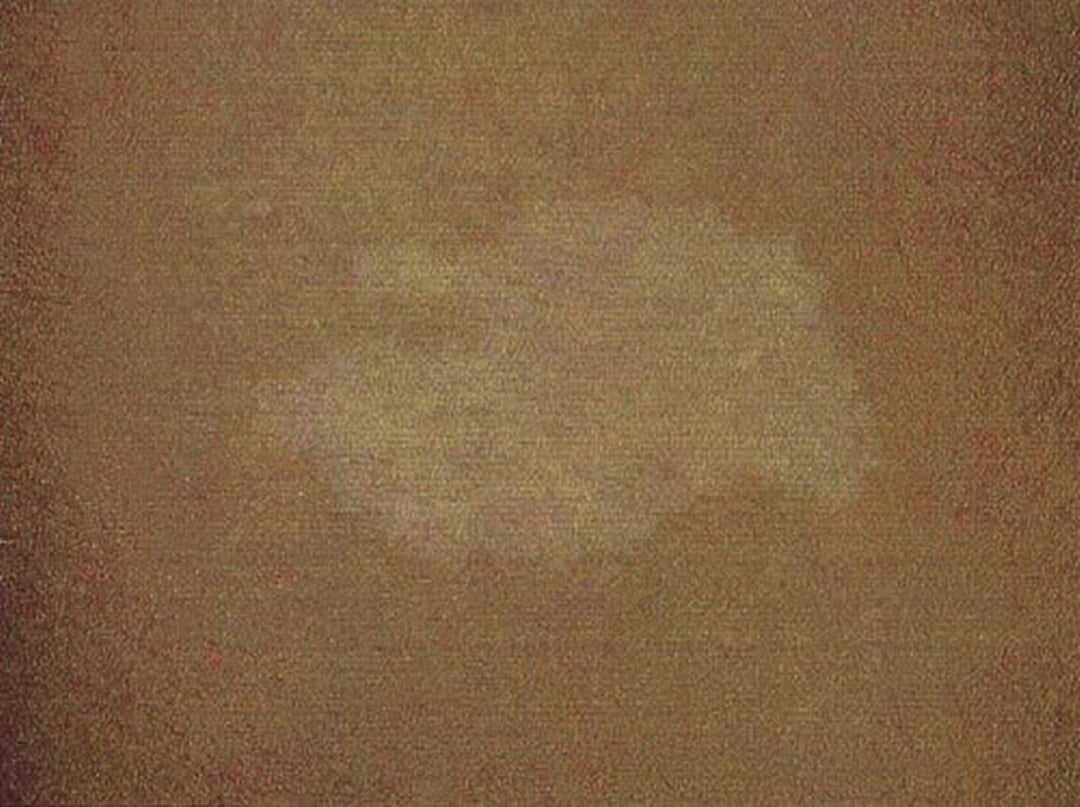 Image:Ash-Leaf Spots in Tuberous Sclerosis Complex-MSD Manual ...