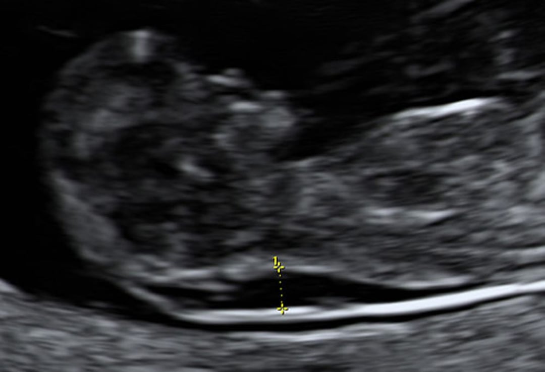 Pruebas de cribado fetal prenatal no invasivas - Pruebas de cribado ...