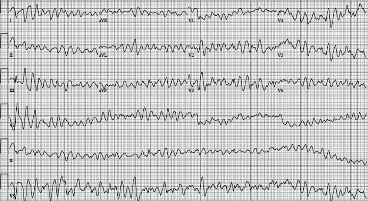 Ventricular Fibrillation (VF) - Cardiovascular Disorders - MSD Manual ...