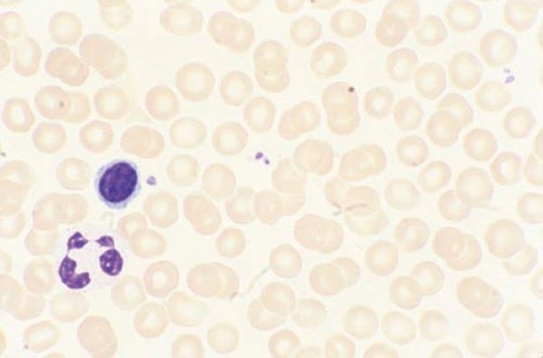 Image:Wright-Giemsa Stain of Peripheral Blood Smear-Merck Manual ...