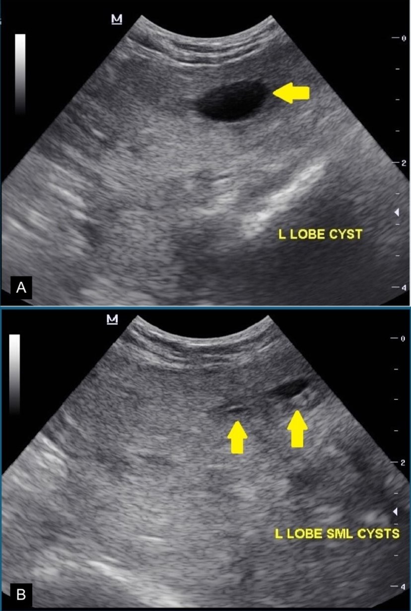 Image:Cystic benign prostatic hyperplasia, transabdominal ...