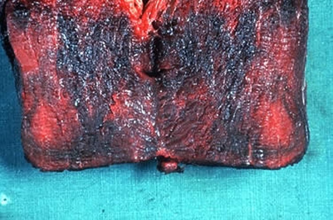 Blackleg in Animals - Infectious Diseases - MSD Veterinary Manual