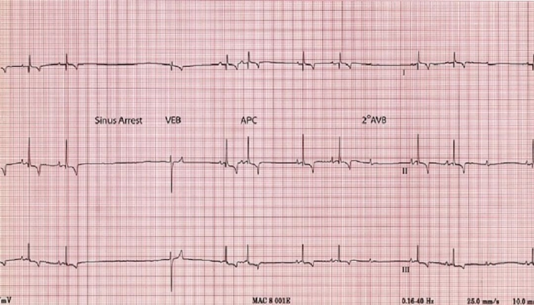 Heart Disease: Conduction Abnormalities in Dogs and Cats - Circulatory ...