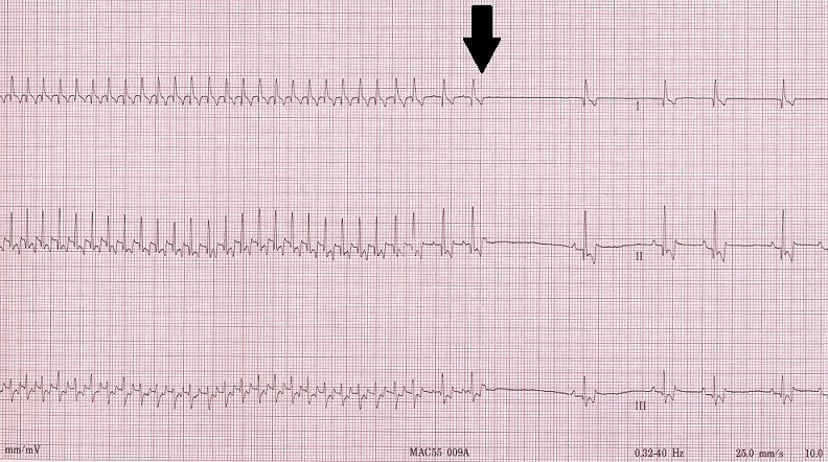 Image:ECG, supraventricular tachycardia, dog-Merck Veterinary Manual