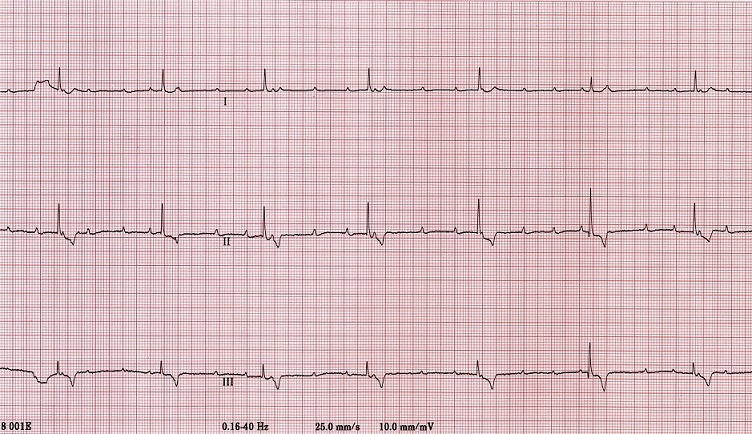 Image:ECG, third-degree (complete) atrioventricular block, dog-MSD ...