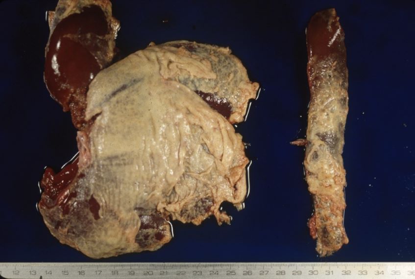 Image:Glässer disease, perihepatitis and perisplenitis, pig-MSD ...