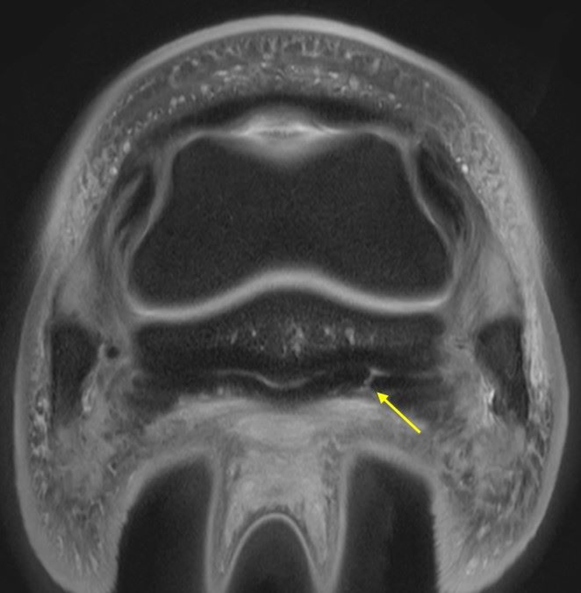 Image:Linear tear, deep digital flexor tendon, MRI, horse-Merck ...