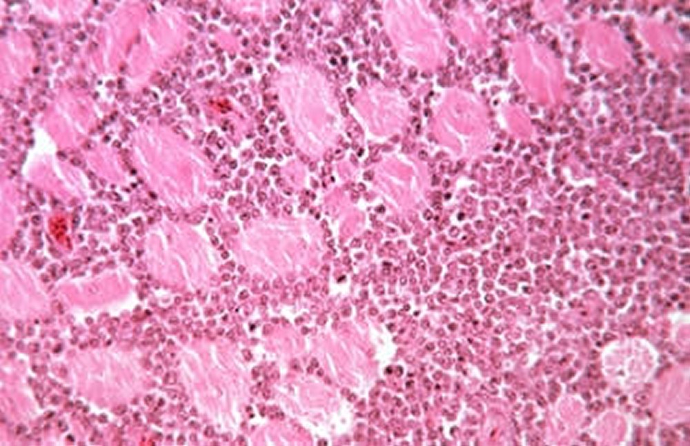 Image:Lymphoid leukosis, lymphocytic infiltration, muscle, chicken ...