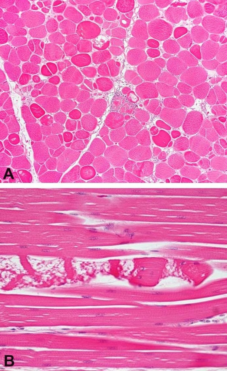 Miscellaneous Myopathies in Poultry - Poultry - Merck Veterinary Manual