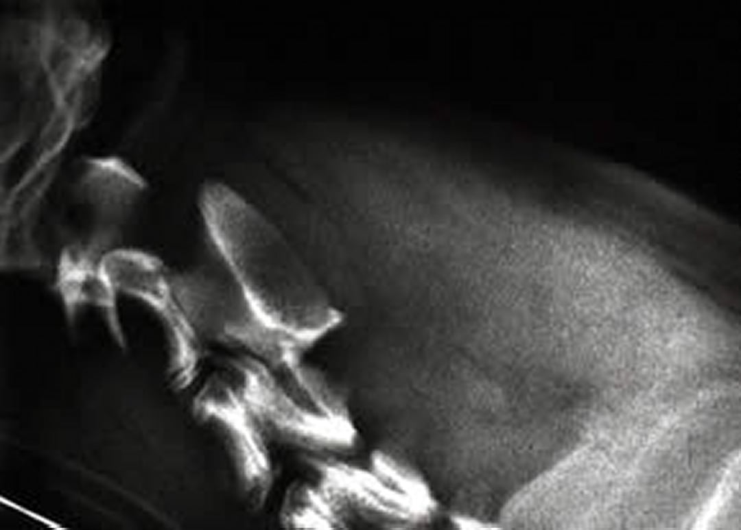 Congenital and Inherited Spinal Cord Disorders in Animals - Nervous ...