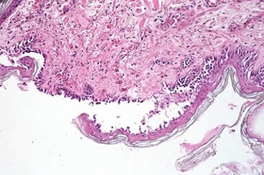 Image:Pemphigus vulgaris, histopathologic lesions, dog-MSD Veterinary ...