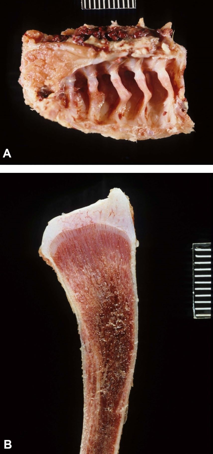 Image:Ribs and tibial growth plate, rickets, broilers-MSD Veterinary Manual