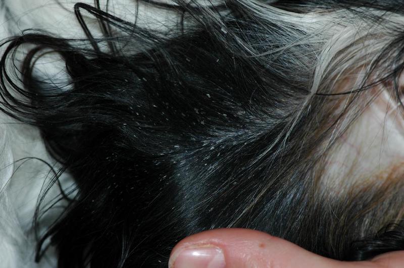 Image:Sebaceous adenitis-Merck Veterinary Manual