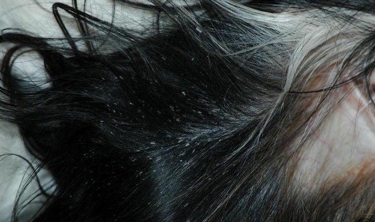 Sebaceous Adenitis Affecting the Pinna in Dogs and Cats - Ear Disorders ...