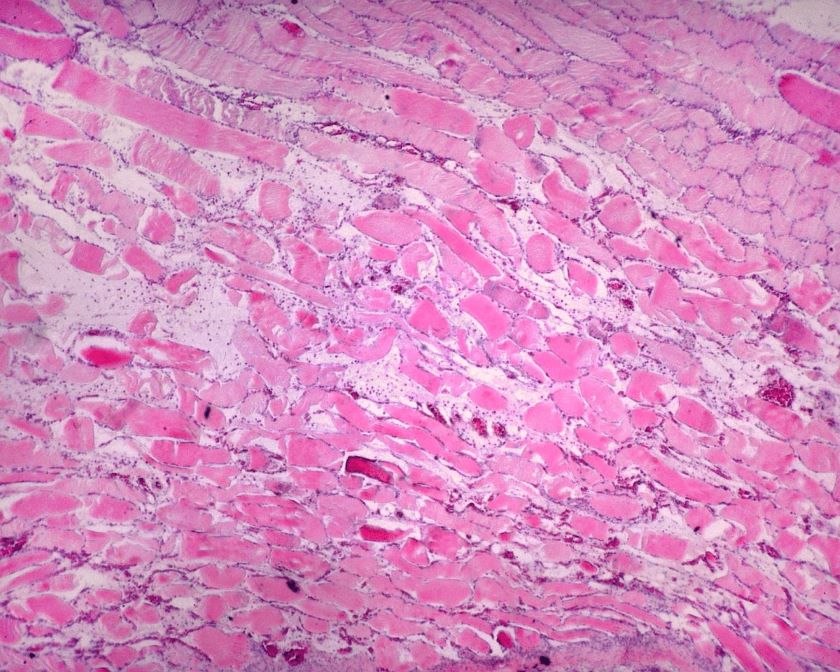 Image:Transport myopathy, photomicrograph, turkey-Merck Veterinary Manual