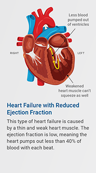 Understanding Heart Failure | Sutter Health