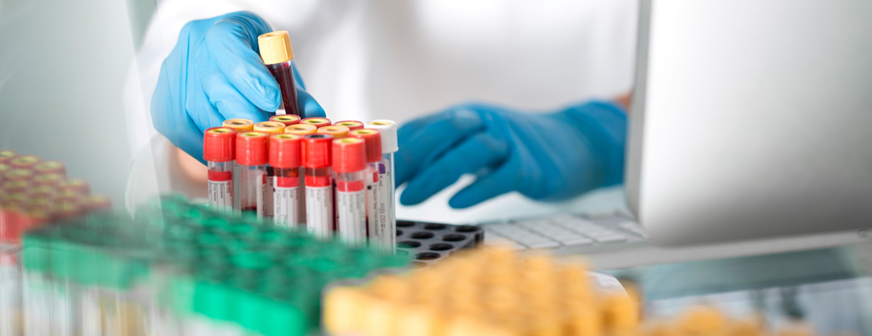 Aldolase blood test | UCSF Health