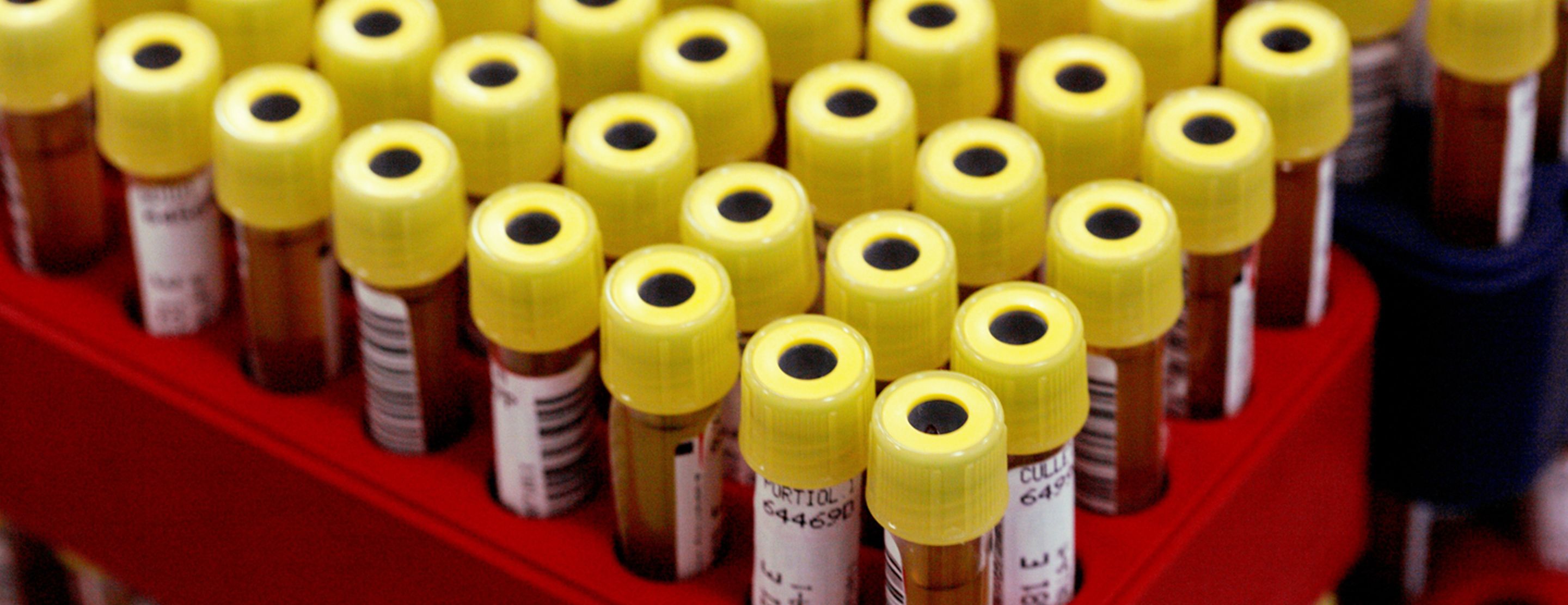 Aspartate aminotransferase (AST) blood test | UCSF Health