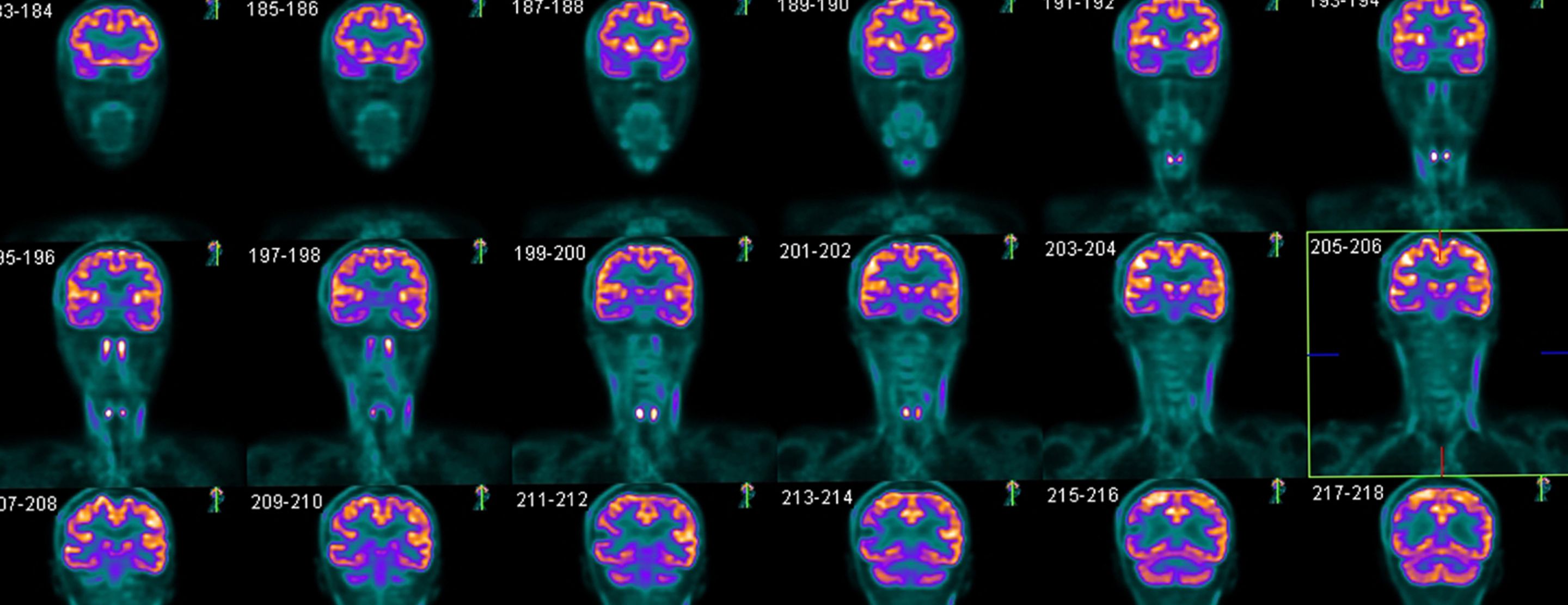 Brain PET scan | UCSF Health
