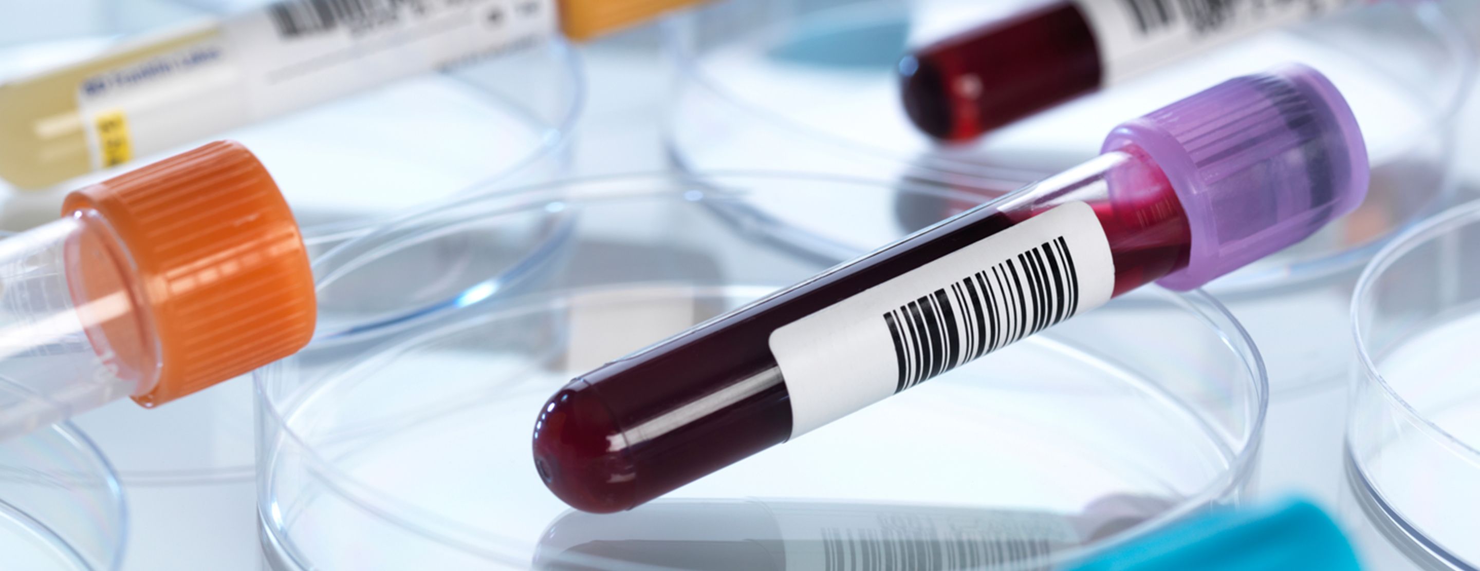 Ceruloplasmin blood test | UCSF Health