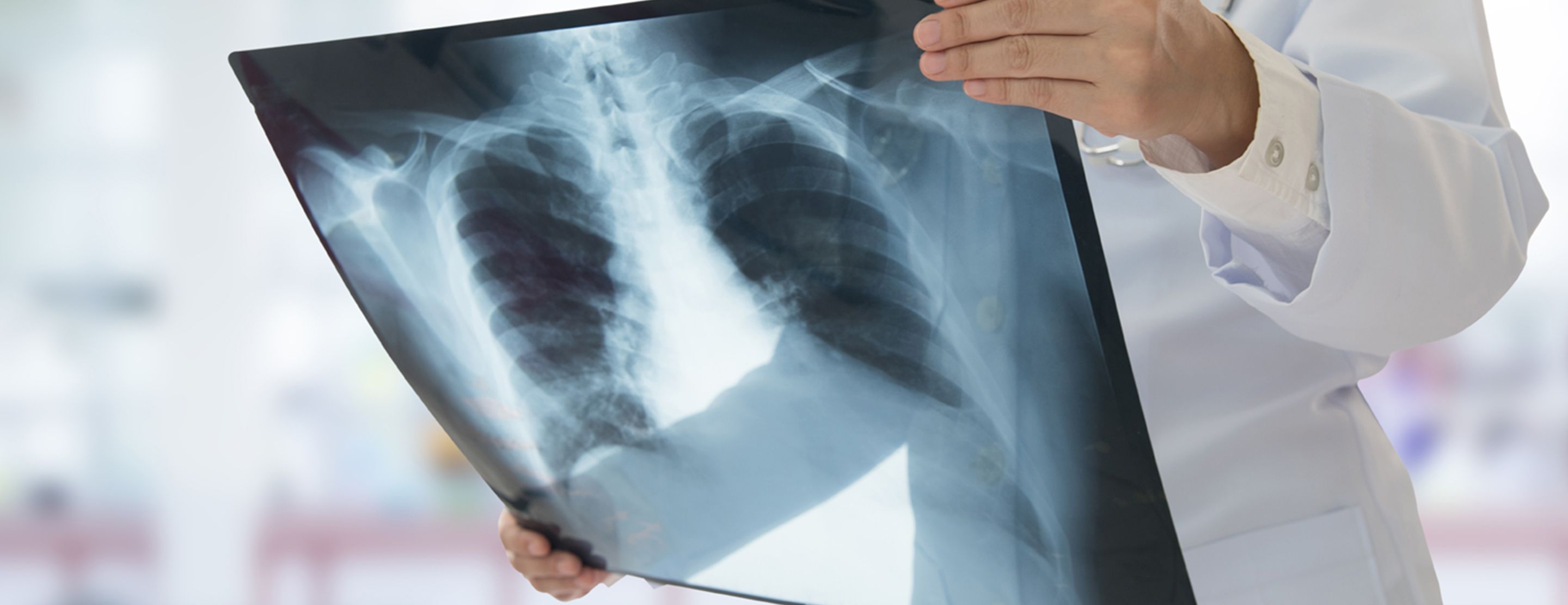 Chest x-ray | UCSF Health