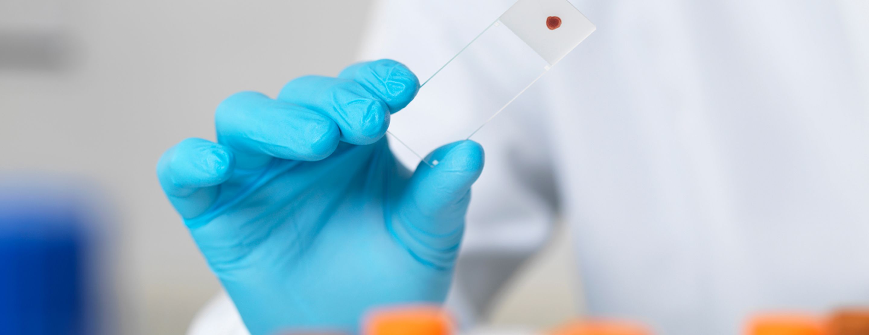 Febrile (warm) and cold agglutinins | UCSF Health