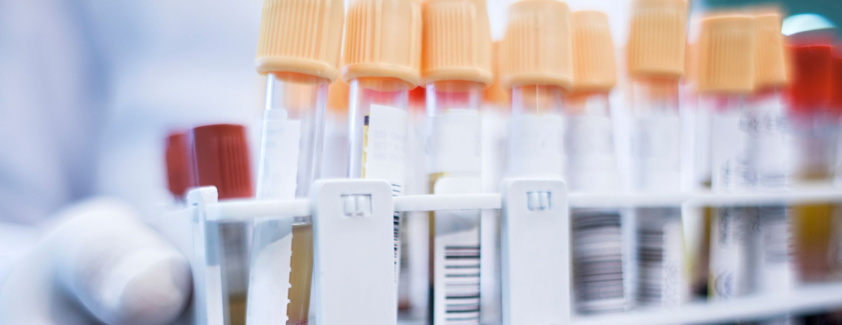 Gastrin blood test | UCSF Health