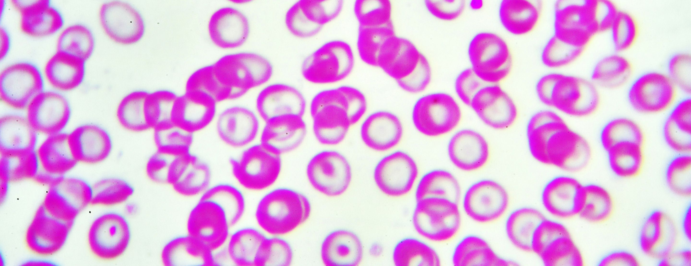 Hypochromia | UCSF Health