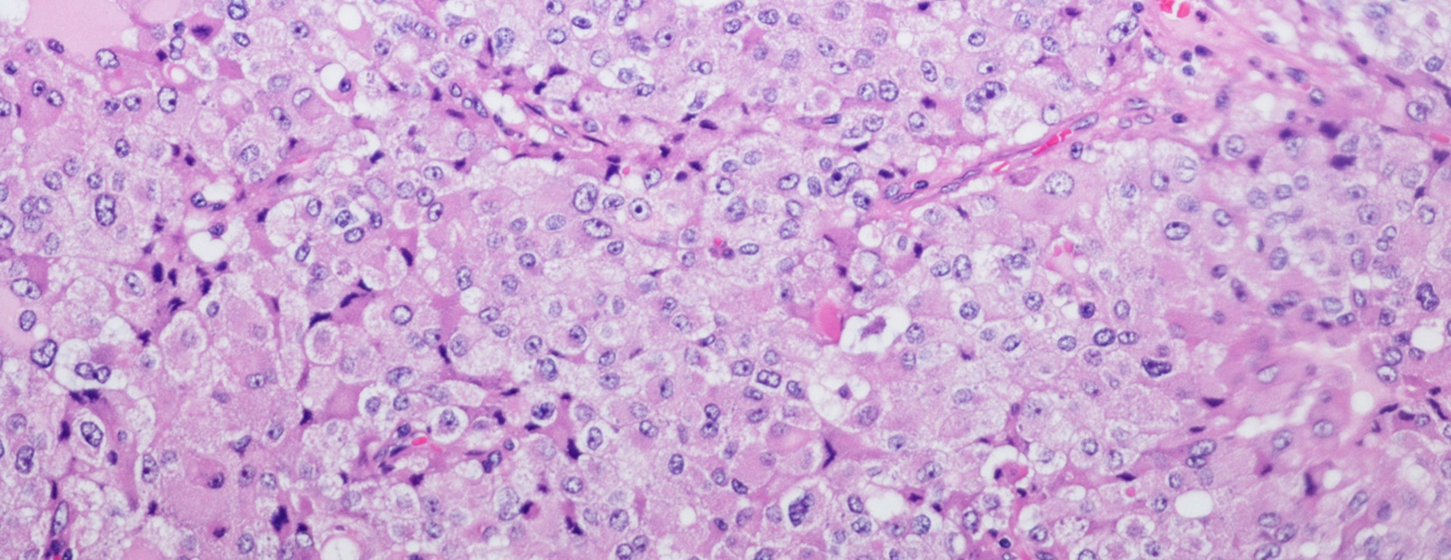 MIBG scintiscan | UCSF Health