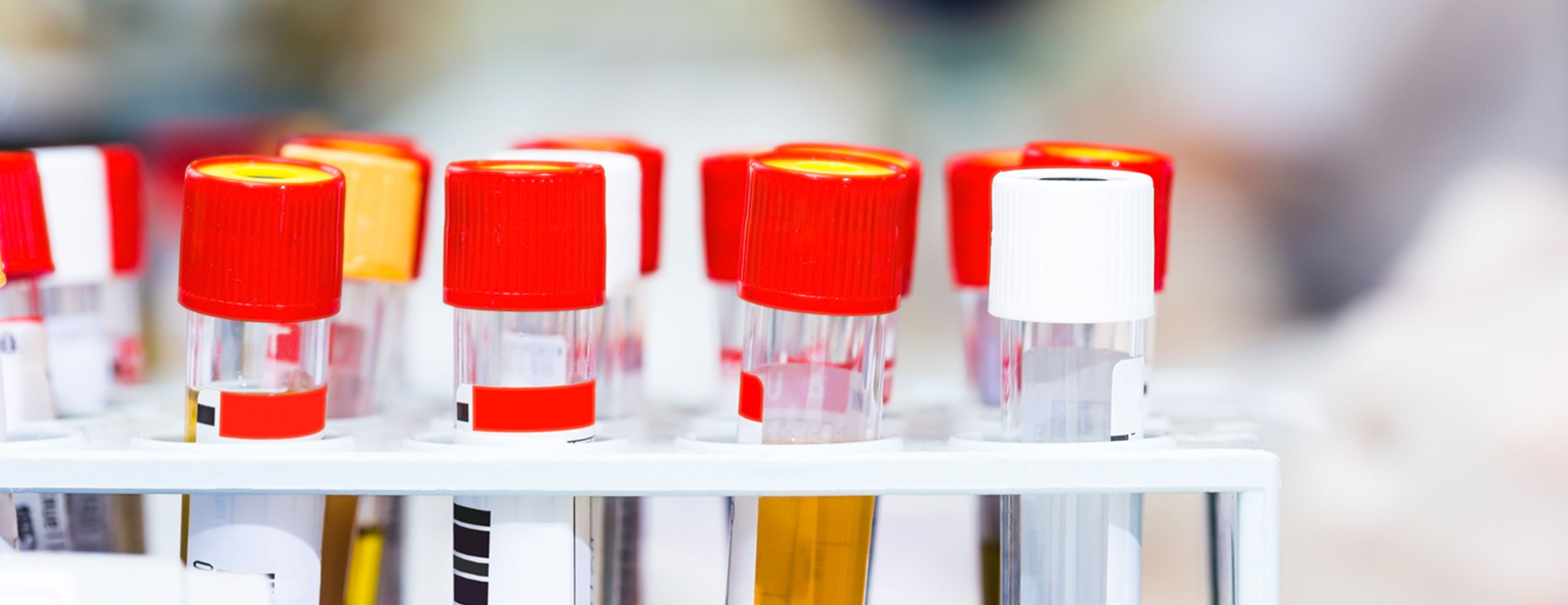 Potassium urine test | UCSF Health