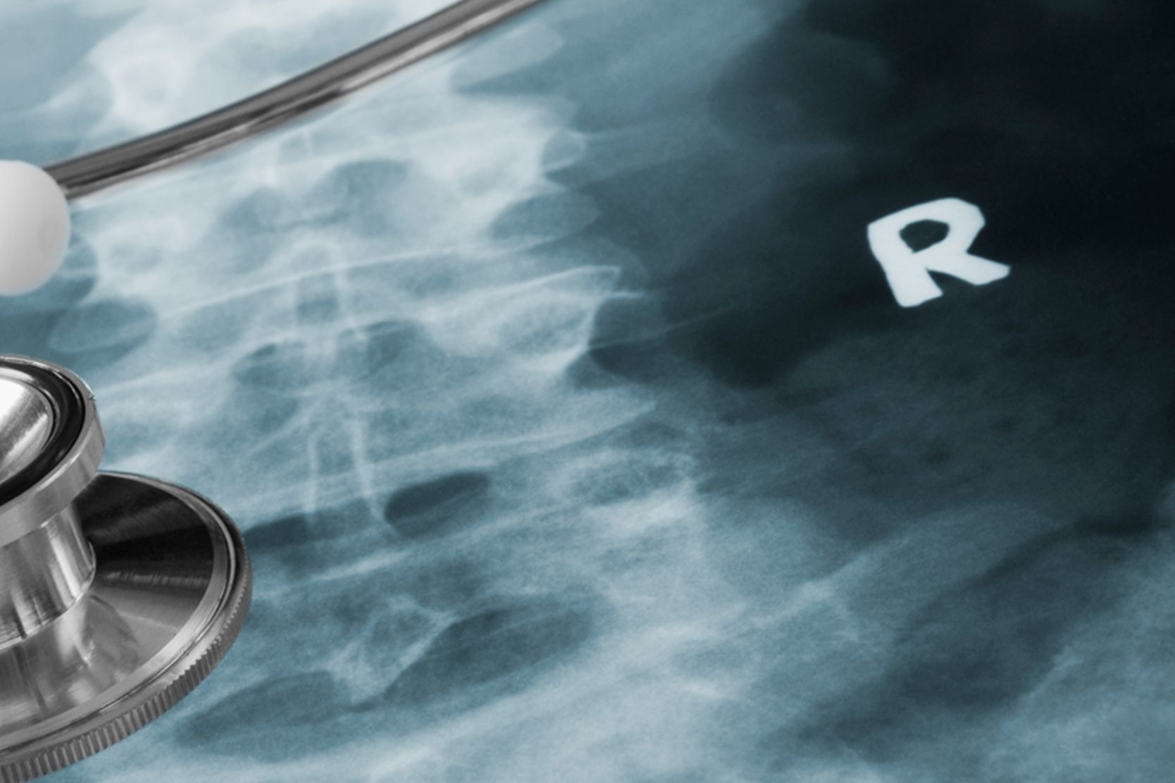 Intrathecal Drug Delivery | Conditions & Treatments | UCSF Health