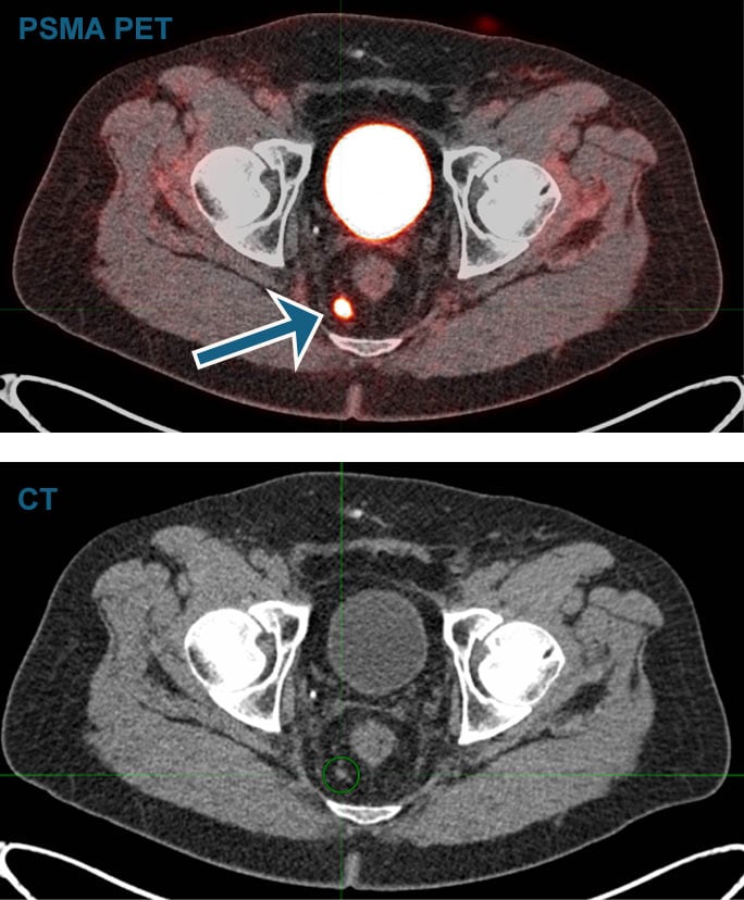 PSMA PET Scan for Prostate Cancer - UChicago Medicine