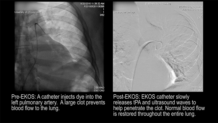 Technique shows dramatic results when treating pulmonary emboli ...
