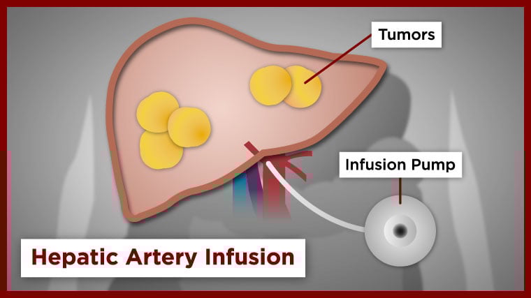 Hepatic Artery Infusion Pump Chemotherapy - UChicago Medicine