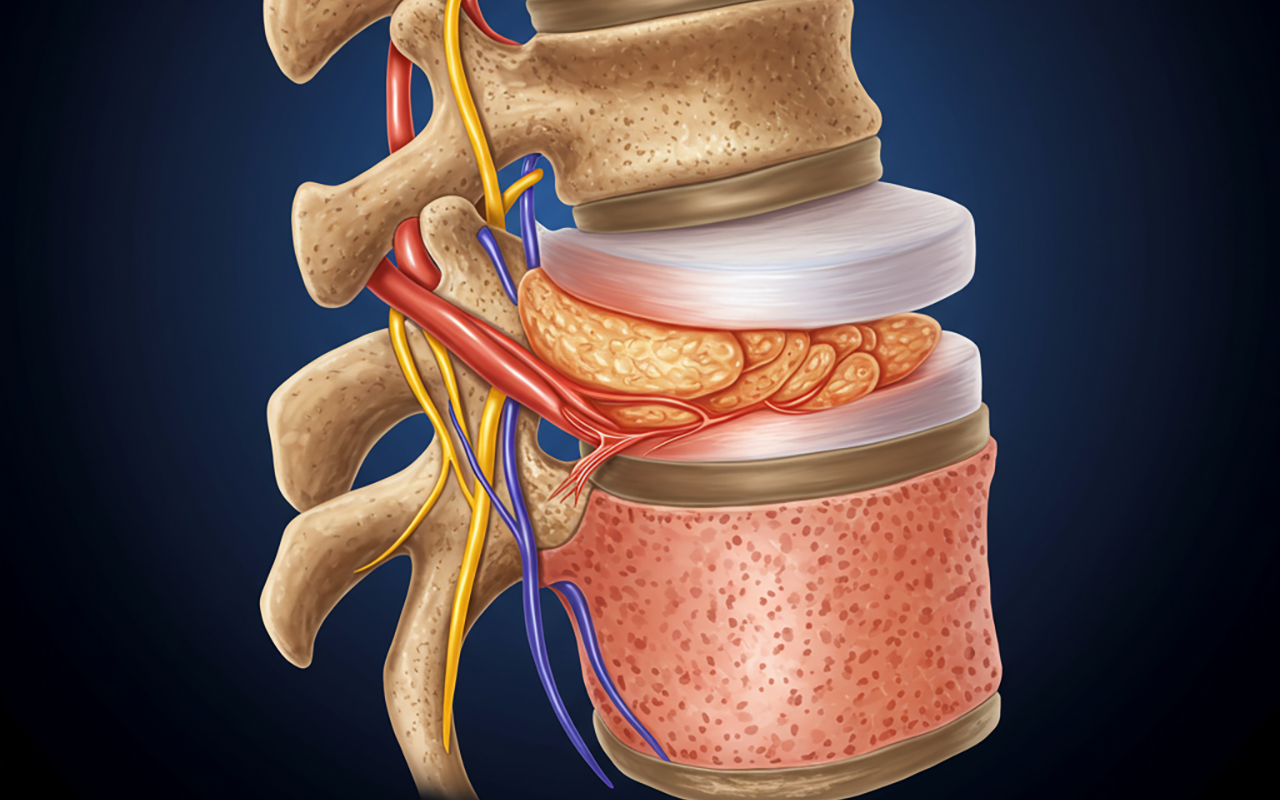 Don’t Ignore These Warning Signs of a Herniated Disc